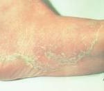 Athletes Foot | PodiatryMed