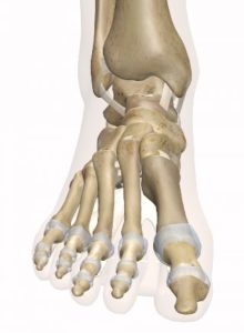 Bursitis – Neuroma Pain – PodiatryMed